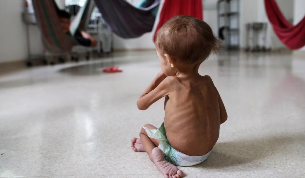 Seis de cada diez niños llegan desnutridos a hospitales del país